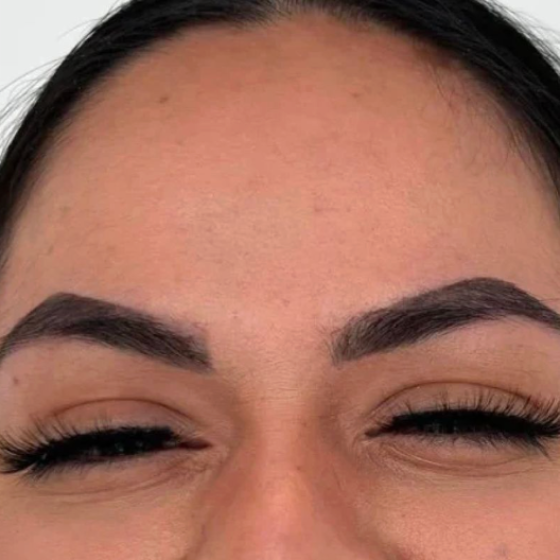 TrueTox – Flat-Fee Wrinkle Treatment | No Units, No Surprises