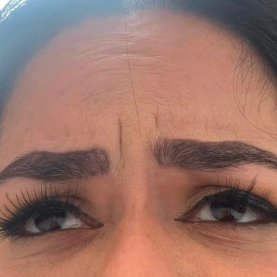 TrueTox – Flat-Fee Wrinkle Treatment | No Units, No Surprises